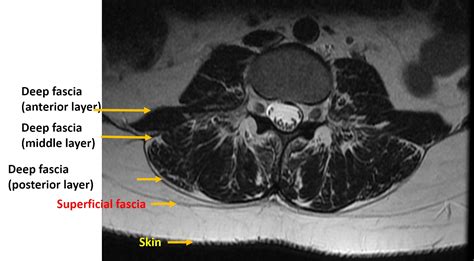Sameer Raniga On Twitter 3 The Blue Dashed Line Represents The Deep Lamina Of The Posterior