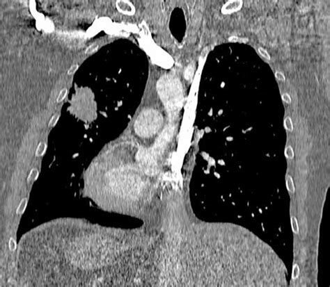 Thoracoscopic Right Upper Lobectomy In A Patient With Situs Inversus Totalis