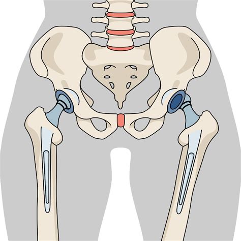 Total Hip Arthroplasty Dislocation Body Figure Science Figures