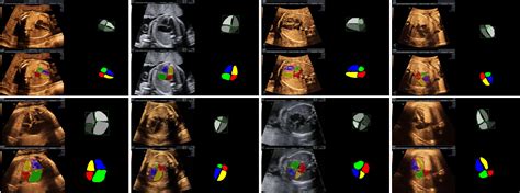 Figure 1 From Simultaneous Segmentation Of Four Cardiac Chambers In