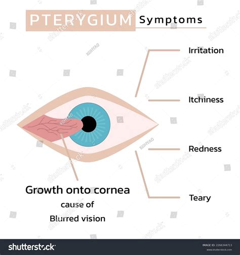 Pterygium Signs Symptoms Vector Stock Vector Royalty Free 2266344713 Shutterstock