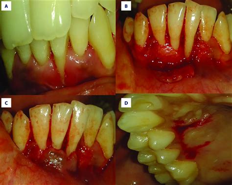 Gingival Recession Coverage With Connective Tissue Graft A Download Scientific Diagram