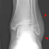 Lateral Malleolus Swelling