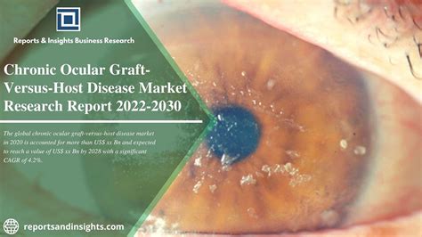 Insights On Chronic Ocular Graft Versus Host Disease Market Recent Developments By Reports And