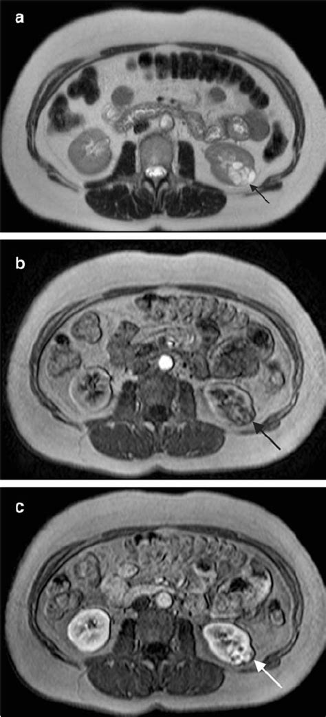 T2 Weighted Turbo Spin Echo Sequence A Showing A Cystic