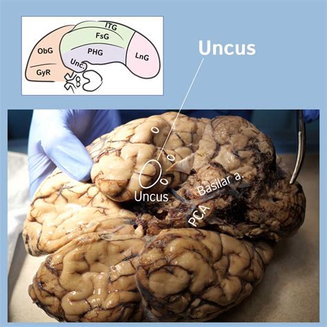Neuroanatomy Glossary Uncus Of Parahippocampal Gyrus Ditki Medical And Biological Sciences