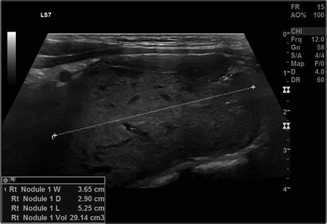 Paraganglioma Of The Recurrent Laryngeal Nerve Aace Clinical Case Reports