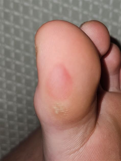 Weird Red Bubble On The Inside Of My Toe Rmedicaladvice