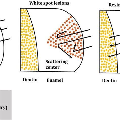 Schematic Illustration Of A White Spot Lesion Of Non Cavitated Enamel