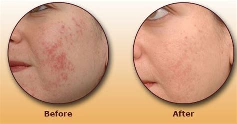 How To Get Rid Of Scars Completely