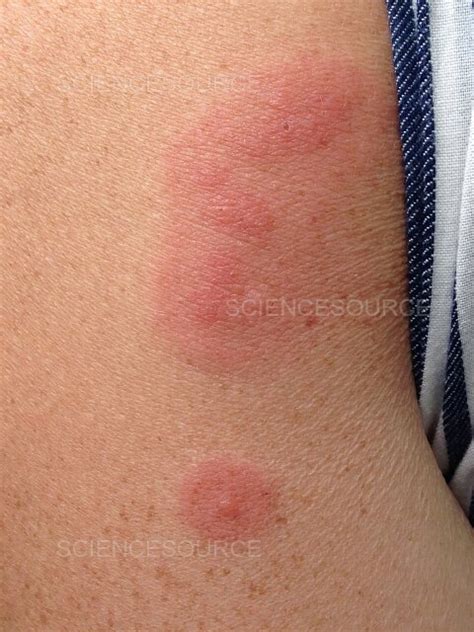Bed Bugs Bites On Arms