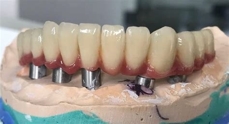 Multiple Teeth Implants Mahimaa Dental Care
