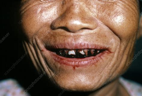 Betel Nut Teeth