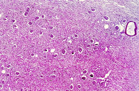 Diffuse Proliferative Glomerulonephritis Light Micrograph Stock Image C048 8586 Science