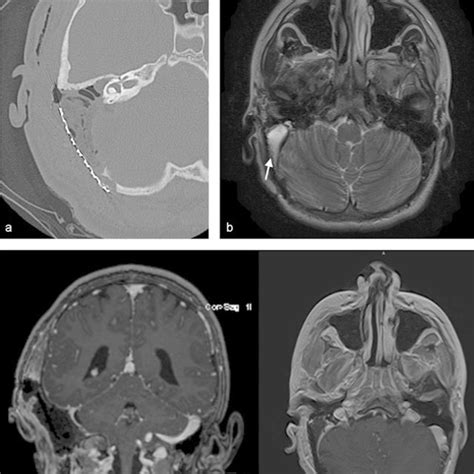 Examples Of Type Ii Vascular Loop Of Aica And Cn Viiviii Complex Aica Download Scientific