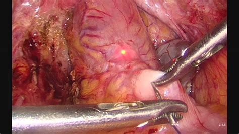 Discoid Resection Of Invasive Rectosigmoid Endometriosis Youtube