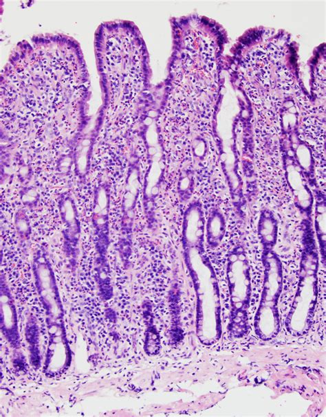Inflammatory Bowel Disease Parasites
