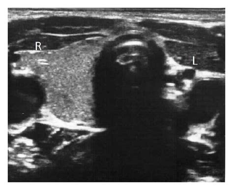 On Transverse Sonogram Of The Thyroid Right Lobe R Displays Normal Download Scientific