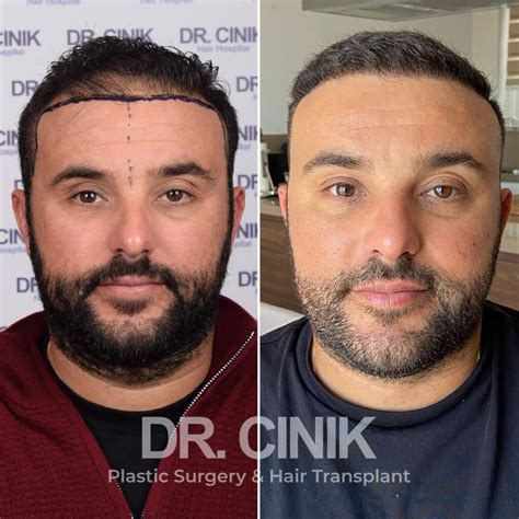 Evolución Del Injerto Capilar Mes A Mes Dr Cinik