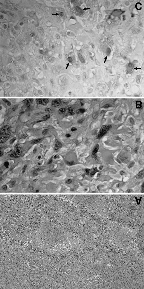 Photomicrographs Of The Surgical Specimen A Fusiform Cells Are