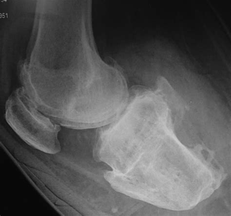 Total Knee Replacement For Tricompartmental Arthritis In A Patient With