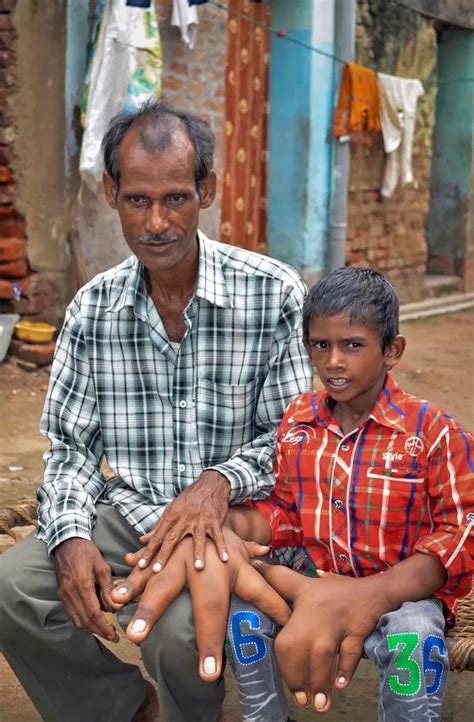 Boy With The Worlds Biggest Hands Measuring 33cm Has Surgery To