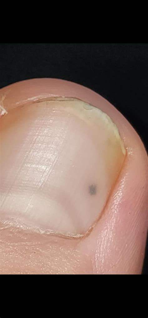 Toenail Melanoma Images At Carolyn Bey Blog
