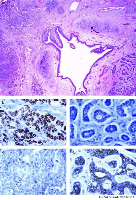 Pulmonar Collision Tumor Metastatic Adenoid Cystic Carcinoma And Lung Adenocarcinoma Pulmonology