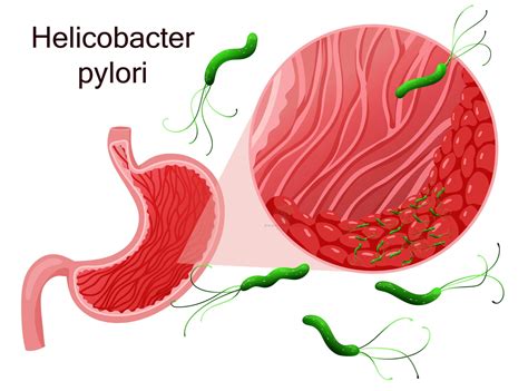 Helicobacter Pylori Infection Pharmacology Mentor