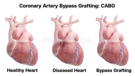 Coronary Artery Bypass Grafting Before And After Stock Illustration