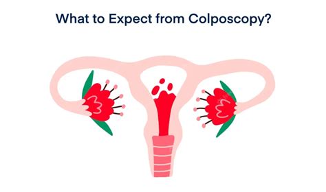 Colposcopy Test Procedure Steps Cost Side Effects And Result