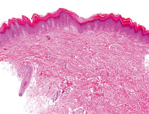 Acral Keratoderma And Sudden Death Diagnostic Histopathology