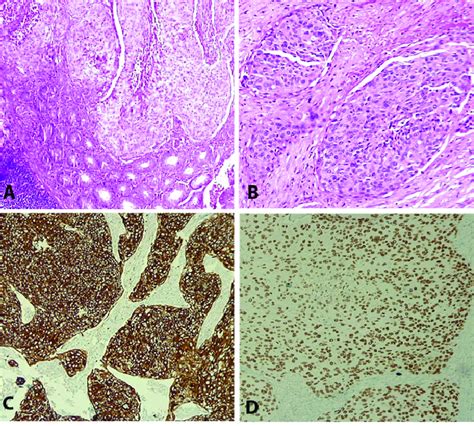 A B The Appendix Wall Was Compromised By Cancerous Cells Characterized Download Scientific