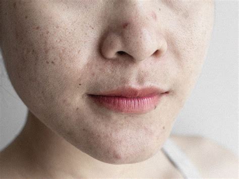 What Is Sebum Function Production Benefits And More