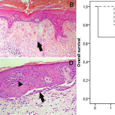 A Vulvectomy Specimen With In Situ Melanoma On The Right Lower Part