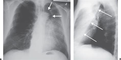Signs Of Lung Collapse On X Ray At Cheryl Franklin Blog