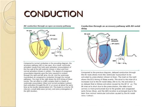 Wpw Syndrome