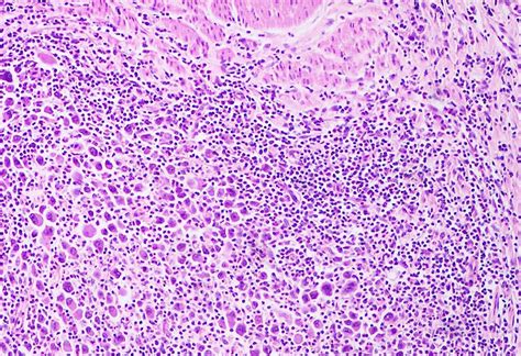 Pathology Outlines Case Of The Week 440