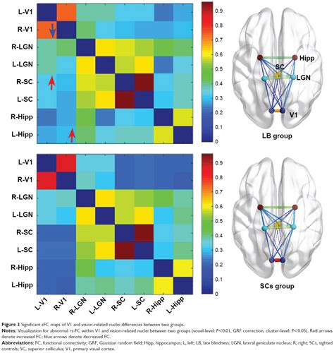 Altered Functional Connectivity Of Primary Visual Cortex In Late Blind Ndt