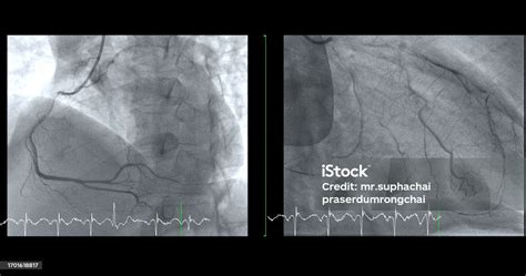 Cardiac Catheterization On Rca And Lad Can Help Doctor Diagnose And Treat Problems In Your Heart