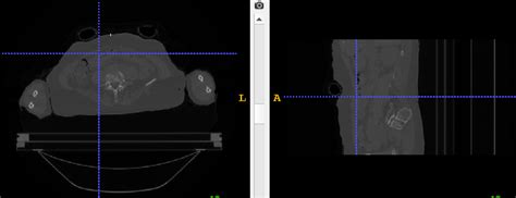 How To Remove The Ct Scanning Bed With Simpleitk Community Itk