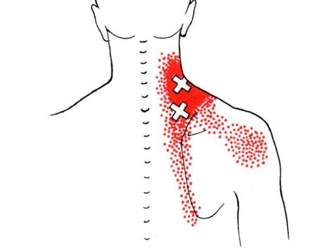 Levator Scapulae Trigger Points How To Identify And Self Release