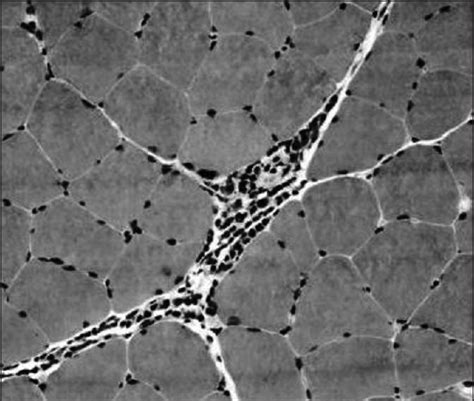 Simultaneous Occurrence Of Scleroderma Neuromyotonia And Inflammatory
