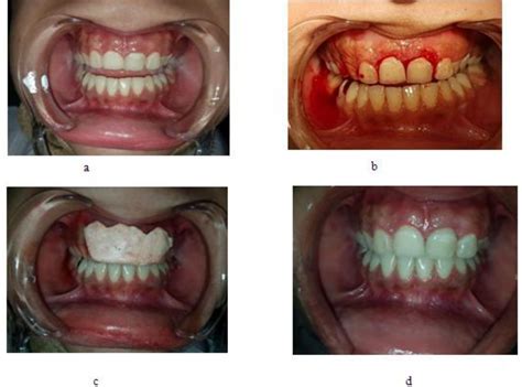 No4localized Gingivectomy By Scalpel For Upper Left And