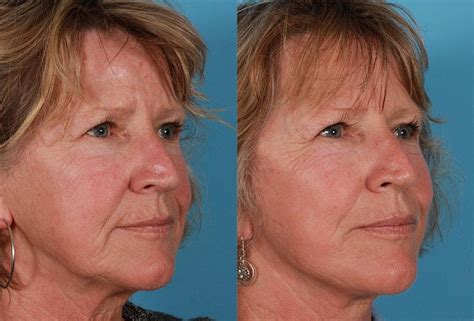 Patient 130114 Limited Incision Facelift Before And After Photos