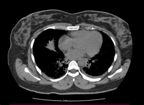Acute Pancreatitis Secondary To Moderate Hypertriglyceridemia A Case Report Authorea