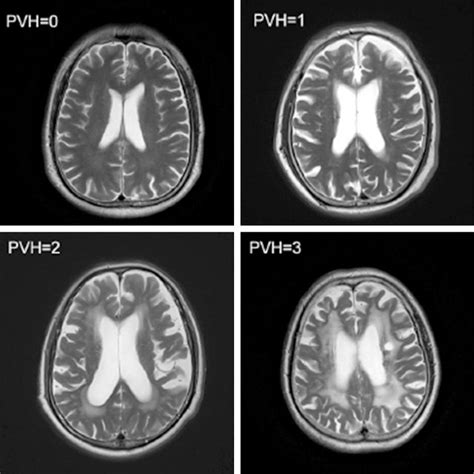 Representative Mri Images Showing Periventricular Hyperintensity Download Scientific Diagram