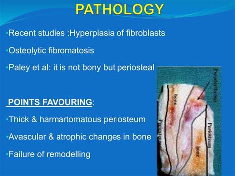 Congenital Pseudoarthrosis Of Tibia Pptx
