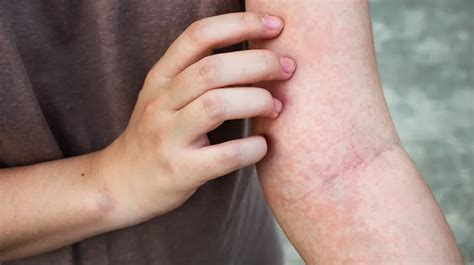 What Cancer Can Cause Itchy Skin Symptoms And When To Seek Help
