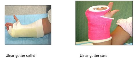 Types Definition Of Different Cast And Splint Pptx